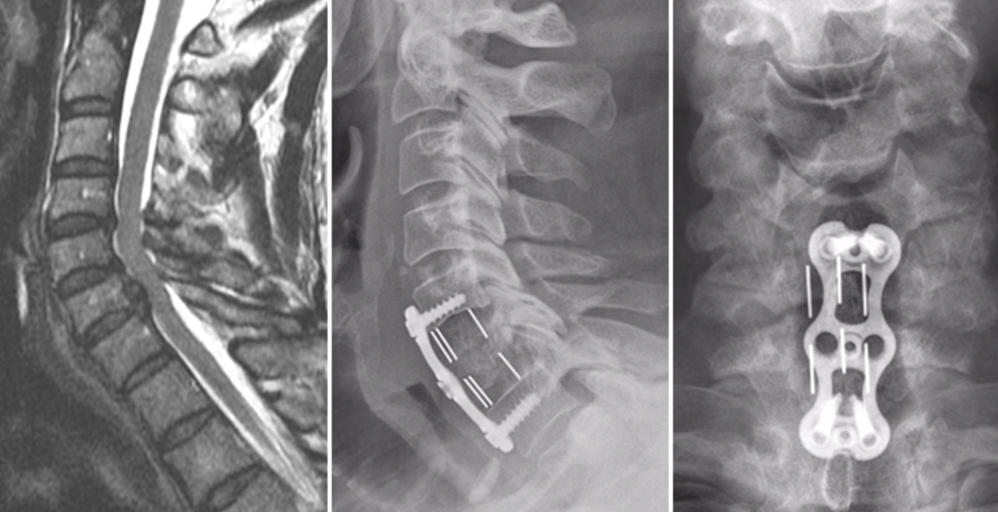 Chirurgie du rachis Lyon – Chirurgie du rachis – Lyon